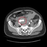 Diferencia fasciculaciones mioclonias | Actualizado diciembre 2025