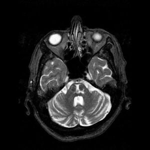 Mioclonias ortostaticas | Actualizado diciembre 2025